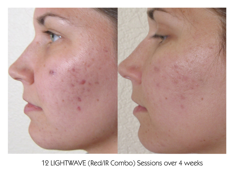 Light Wave Treatment - Aesthetics and Costmetics | Maui Hawaii